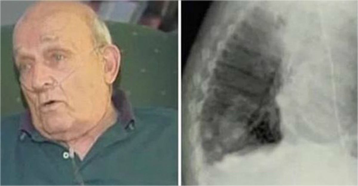 Lo Que Tenía Este Hombre En Su Pulmón Dejó A Los Doctores En Shock…. Y ...